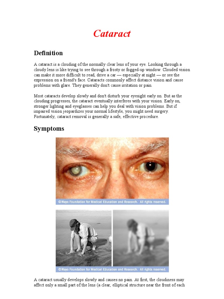 Cataract | PDF | Cataract | Human Eye
