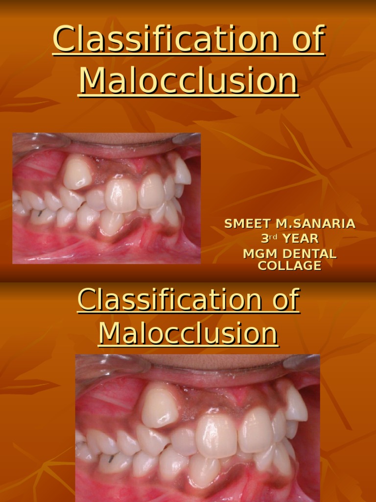 Classification of Malocclusion Project MGM Dental | PDF | Face | Facial ...