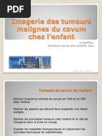 Cancer du Cavum : Diagnostic et Traitement | PDF | Cancer | Métastase