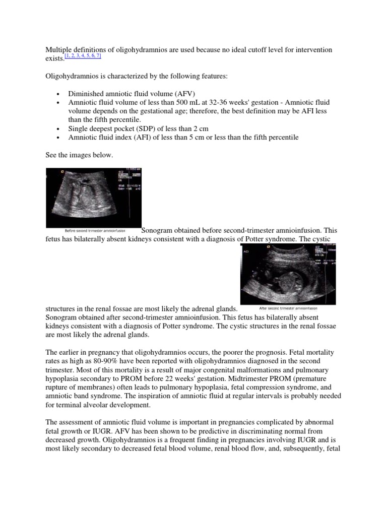 Oligohydramnios | PDF | Pregnancy | Fetus