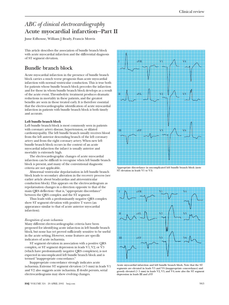Acute Myocardial Infarction-Part II: ABC of Clinical ...
