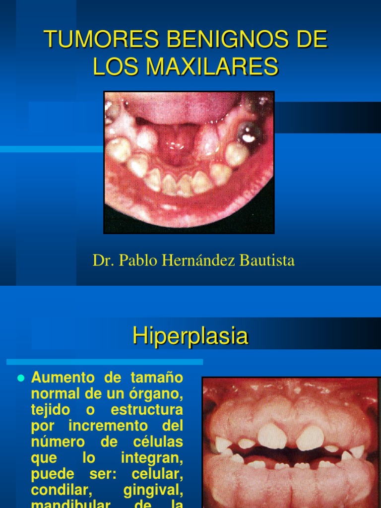 Tumores Benignos de Los Maxilares | PDF | Hueso | Cáncer