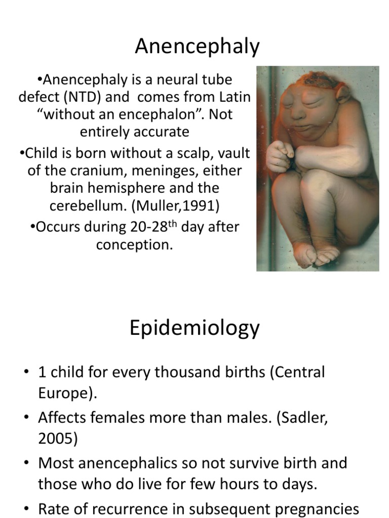 Anencephaly | PDF | Pediatrics | Diseases And Disorders