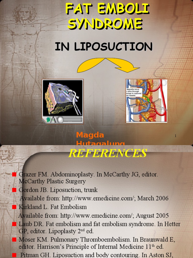 Fat Emboli in Liposuction | PDF | Embolism | Anesthesia