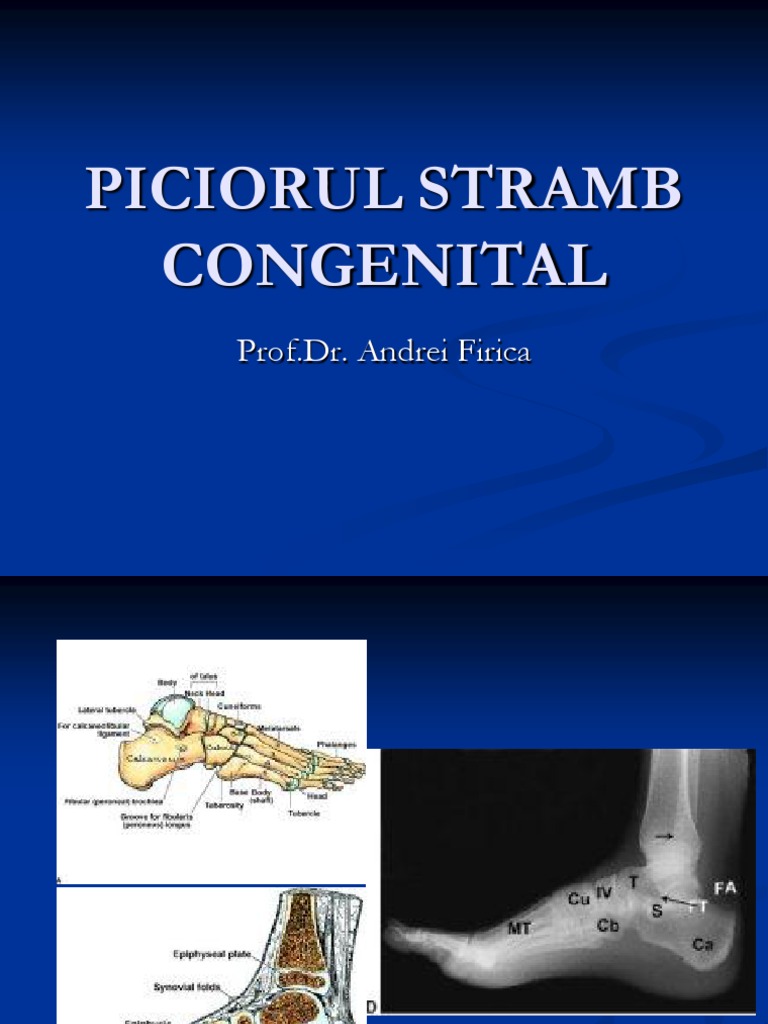 Piciorul Stramb Congenital