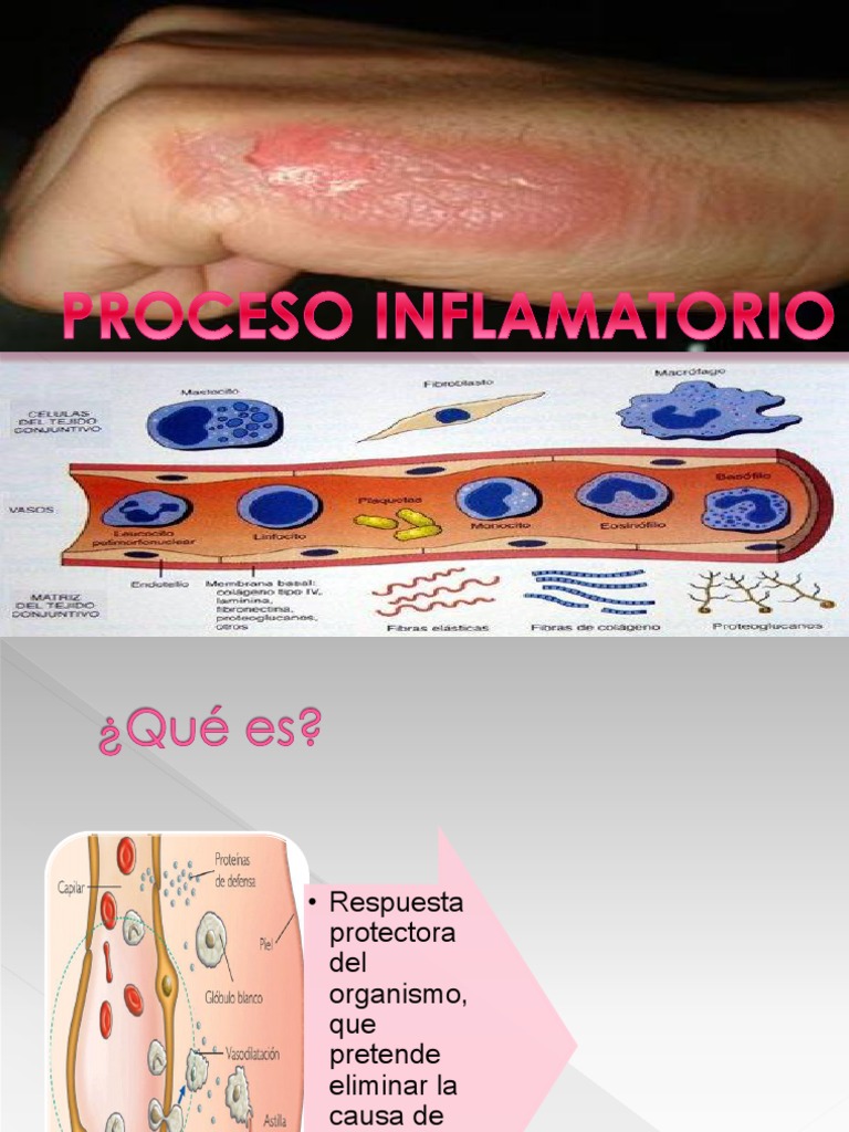 Proceso Inflamatorio In | Inflamación | Citocina
