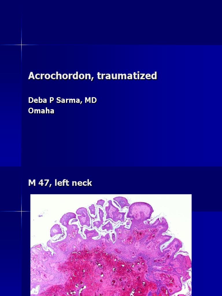 Acrochordon, Traumatized. M 47, Left Neck | PDF