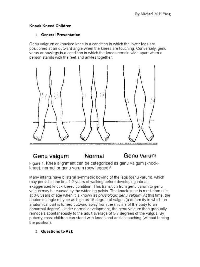Knock Kneed Children: Knee Alignment Can Be Categorized As Genu Valgum ...