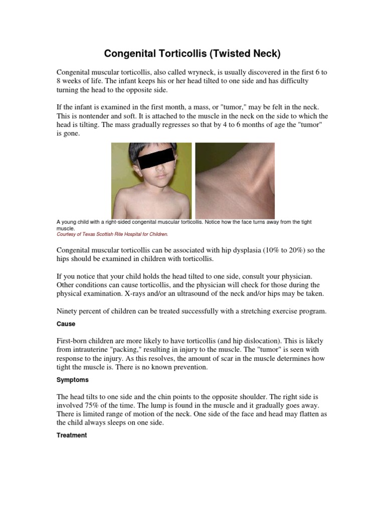 Congenital Torticollis Pdf Medicine Diseases And Disorders
