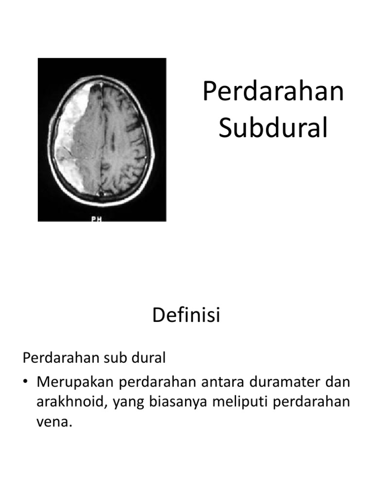 Perdarahan Subdural Atau Subdural Hematom | PDF