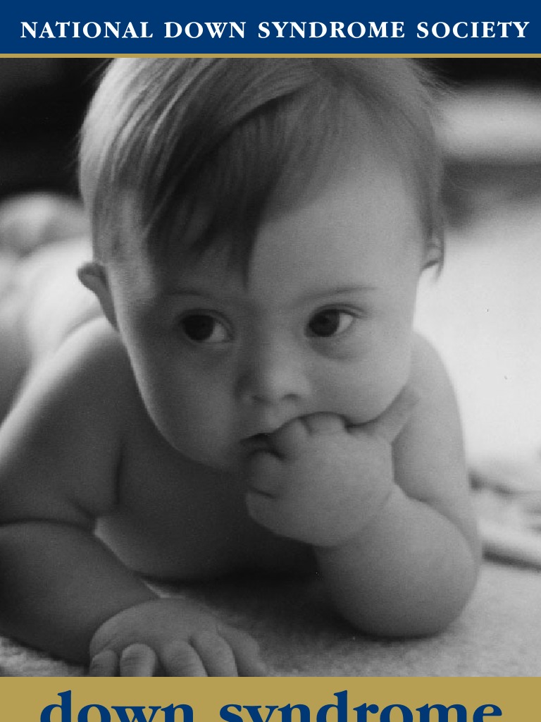 Down Syndrome | PDF