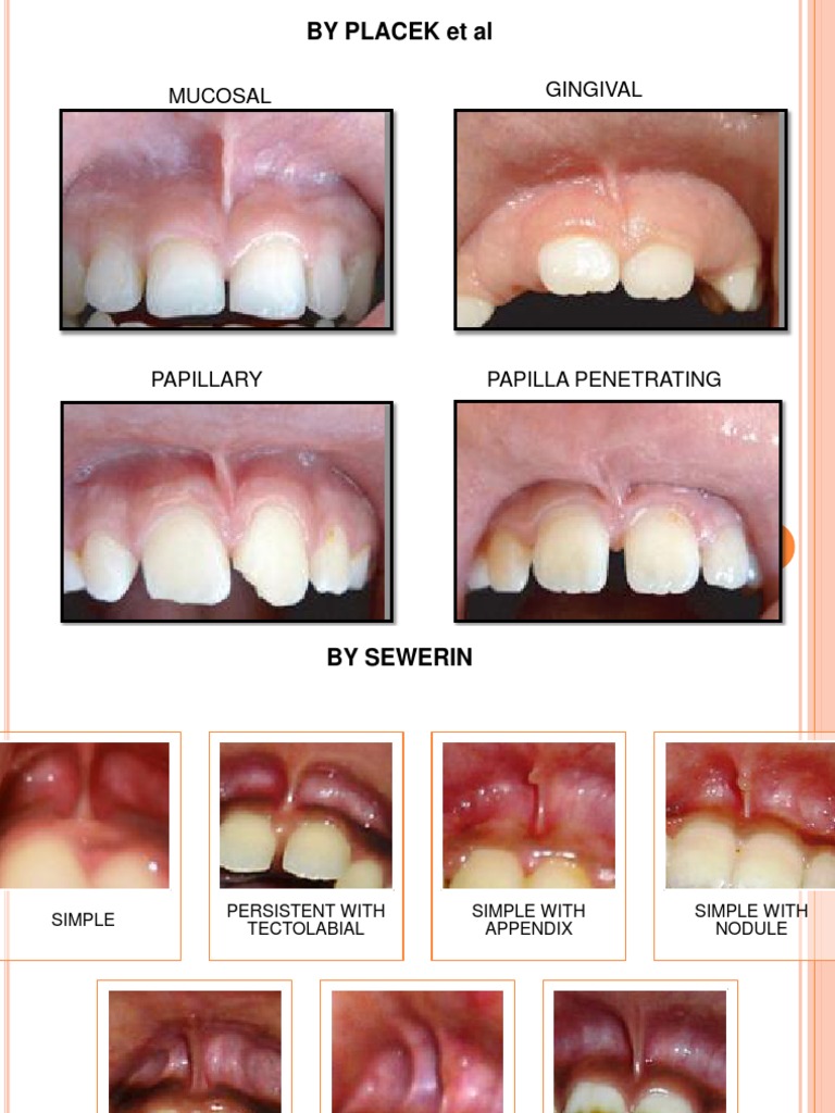 Frenulum Plasty Techniques Overview | PDF | Wellness
