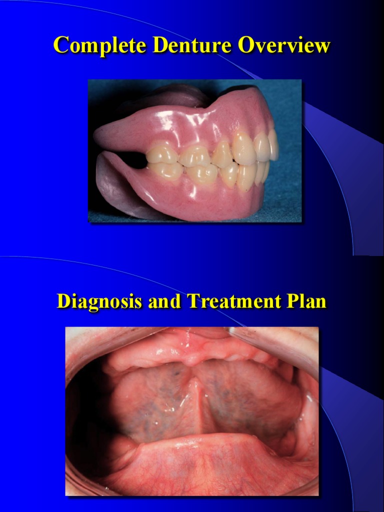 Complete Denture Overview