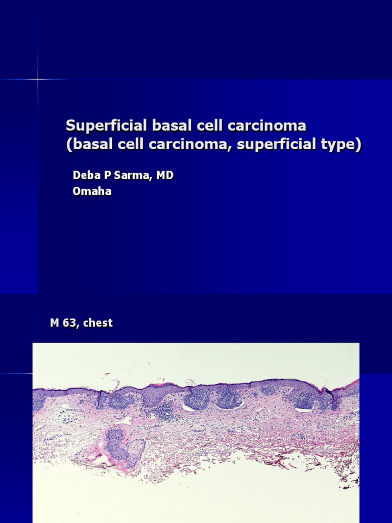Basal Cell Carcinoma, Superficial Type, M 63 Chest | PDF