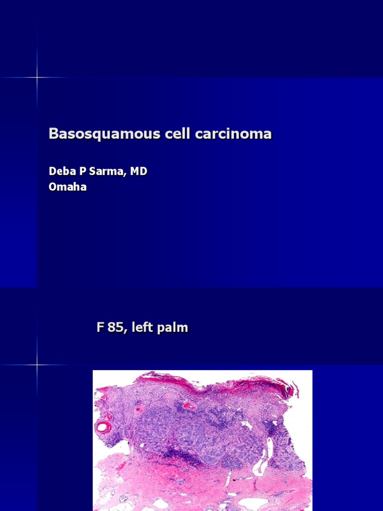 Basosquamous Cell Carcinoma | PDF