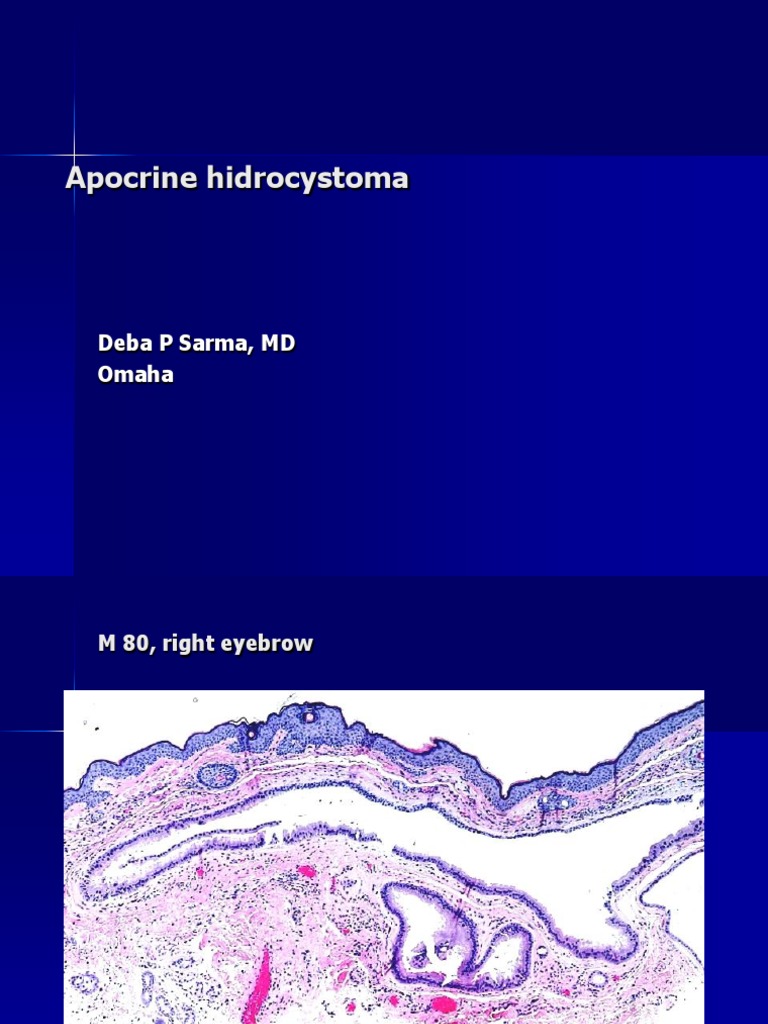 Benign Adnexal Tumor, Apocrine Hidrocystoma | PDF