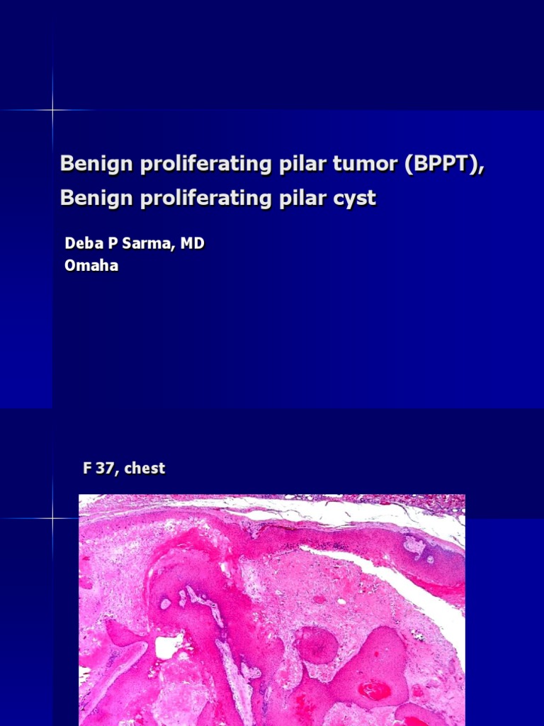 Benign Proliferating Pilar Tumor (BPPT), Benign Proliferating Pilar Cyst | PDF