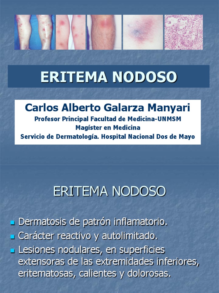 ERITEMA NODOSO | Inflamación | Cáncer
