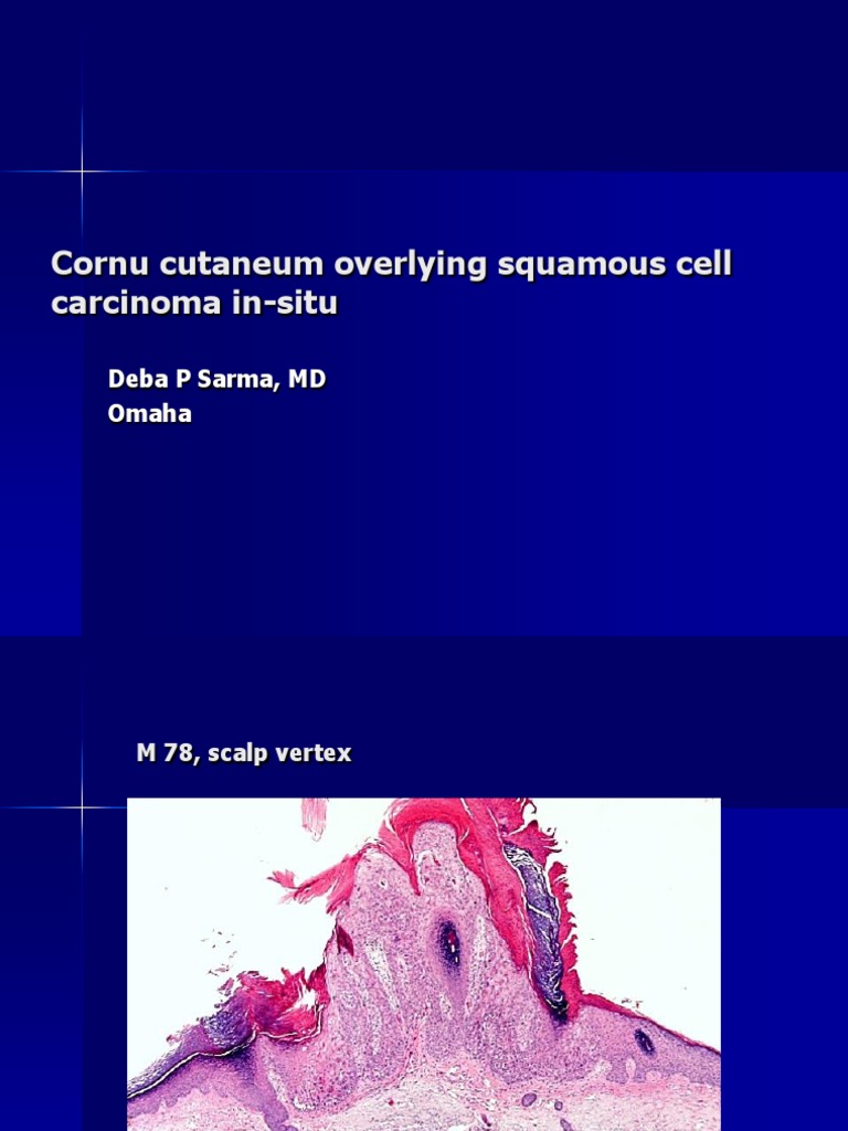 Cornu Cutaneum Overlying Squamous Cell Carcinoma In-Situ | PDF