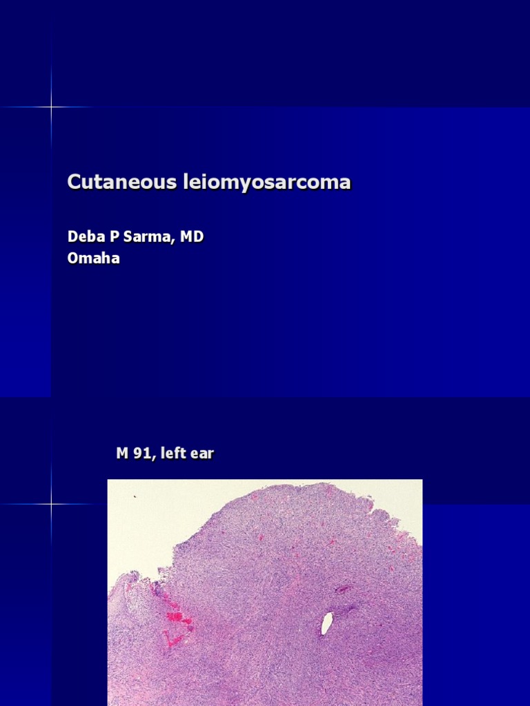Cutaneous Leiomyosarcoma Diagnosis | PDF | Sports & Recreation | Wellness