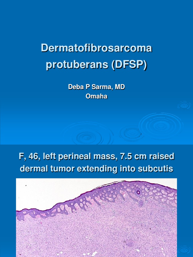 Dermatofibrosarcoma Protuberans (DFSP) - F 46, Perineal Skin | PDF