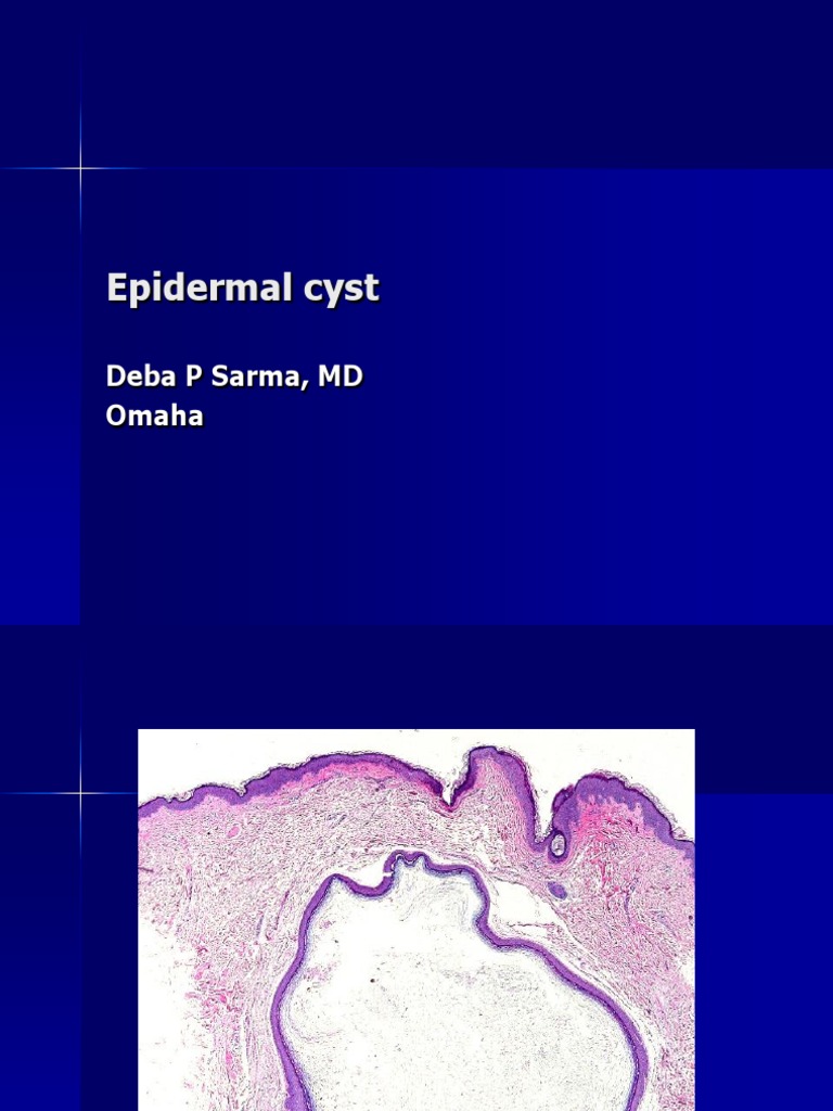 Epidermal Cyst | PDF