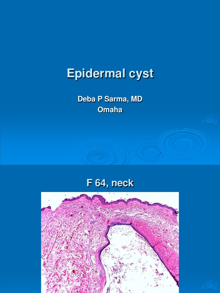 Epidermal Cyst. F 64, Neck | PDF