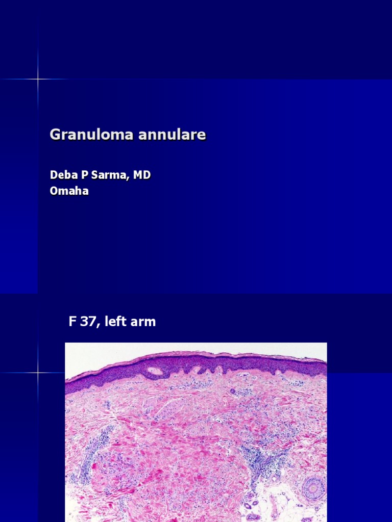 Granuloma Annulare.F 37, Left Arm | PDF