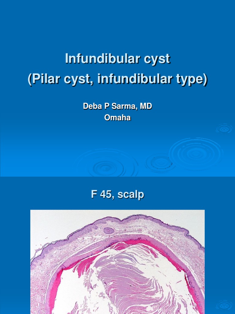 Infundibular Cyst, F 45, Scalp | PDF
