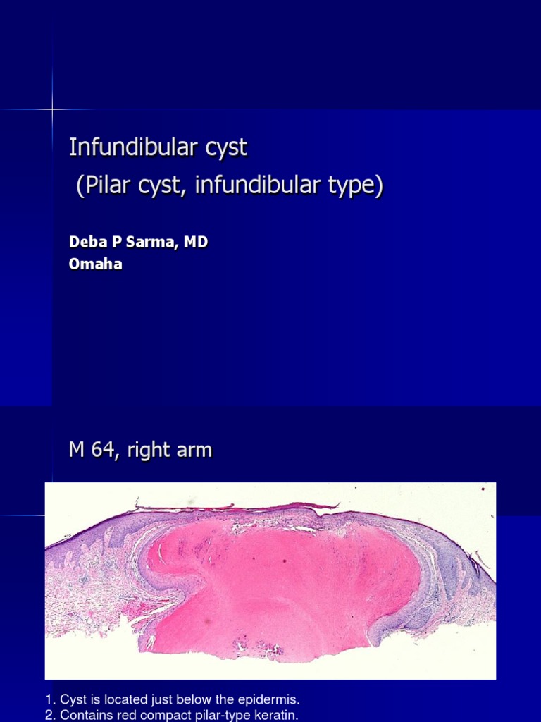 Infundibular Cyst. M 64, Right Arm | PDF