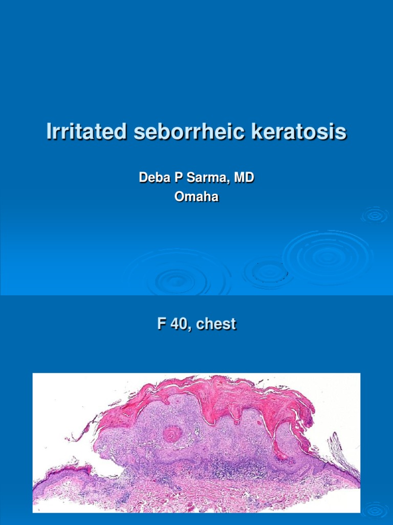 Irritated Seborrheic Keratosis, F 40, Chest | PDF