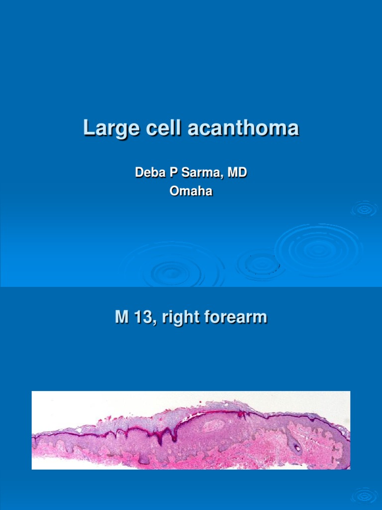 Large Cell Acanthoma Overview | PDF | Wellness | Science & Mathematics