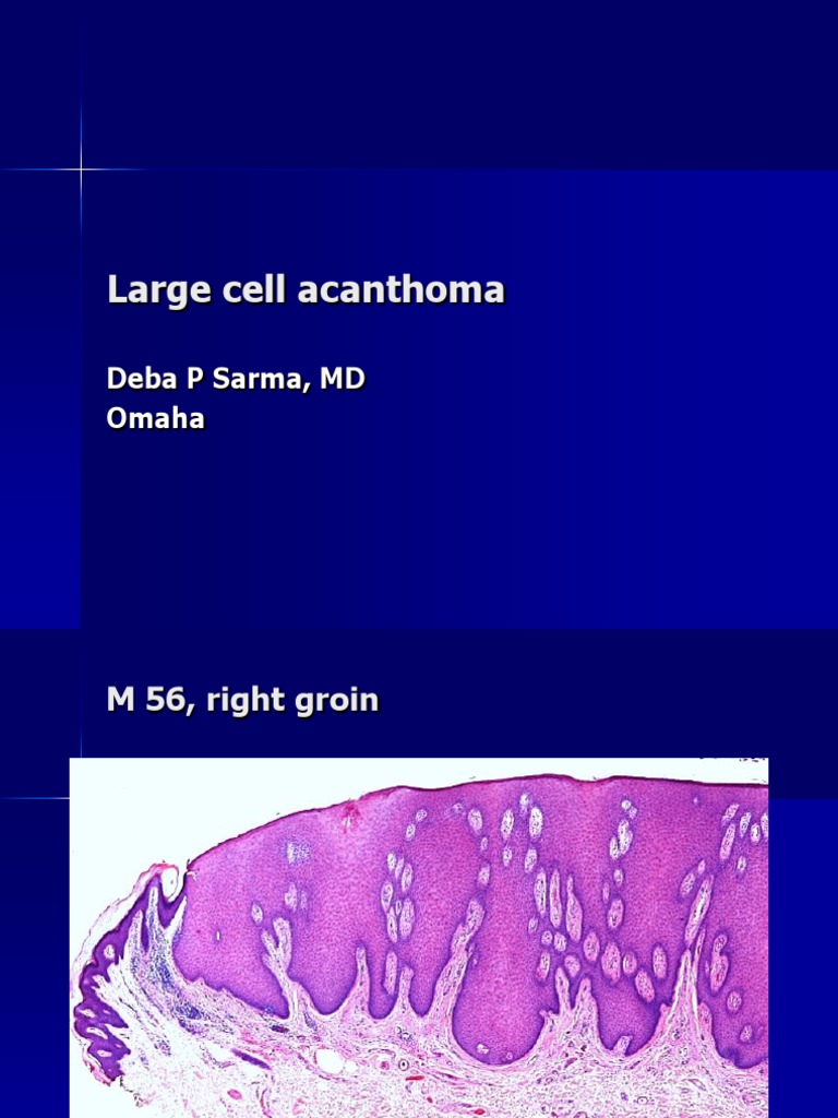Large Cell Acanthoma., M 56, Right Groin | PDF