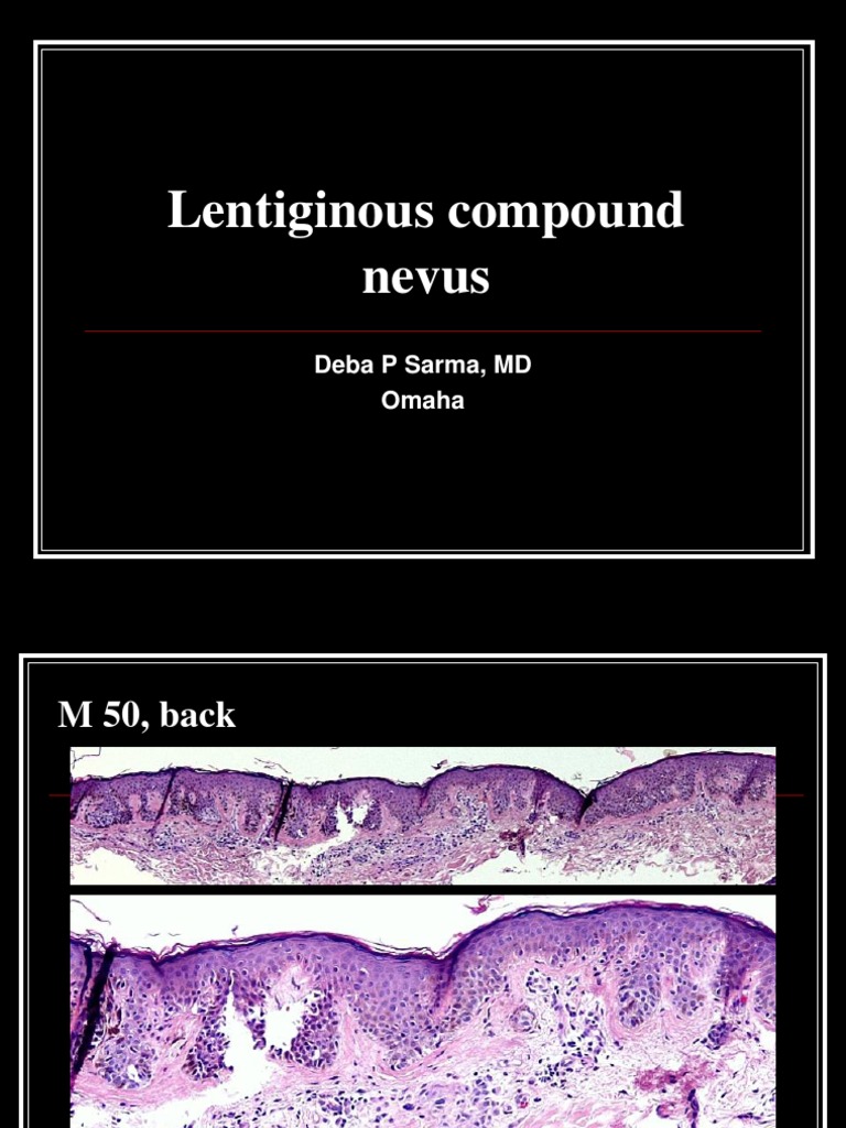 Lentiginous Compound Nevus. M 50, Back | PDF