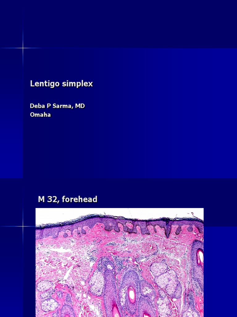 Lentigo Simplex Biopsy Results | PDF | Cutaneous Conditions | Dermatology
