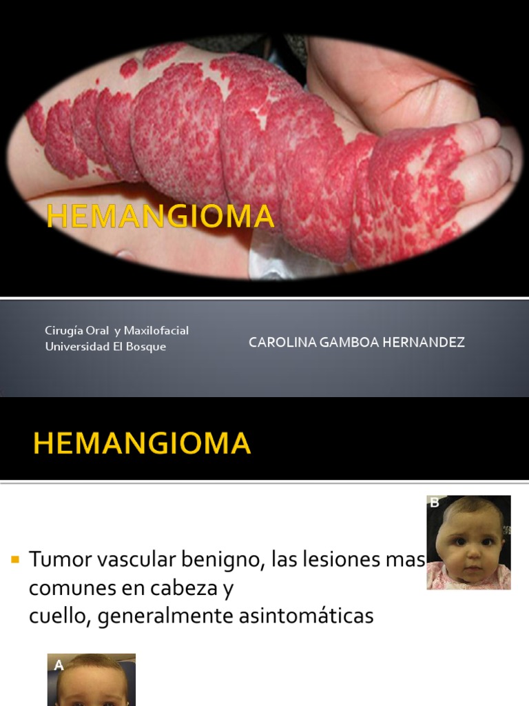 Hemangioma | PDF | Especialidades Medicas | Medicina CLINICA