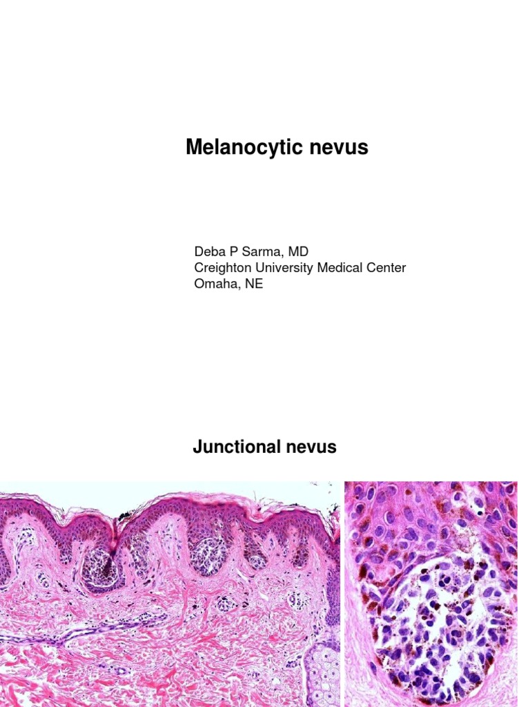 Junctional Nevus Overview | PDF