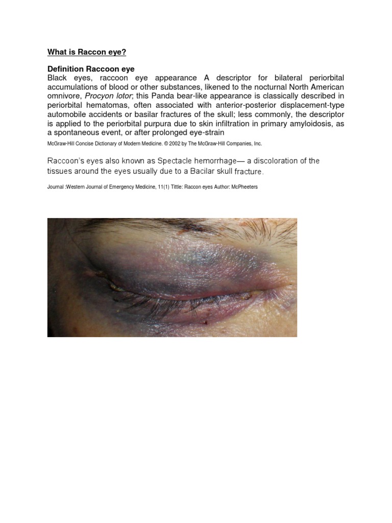 What Is Raccon Eye | PDF | Human Head And Neck | Injury