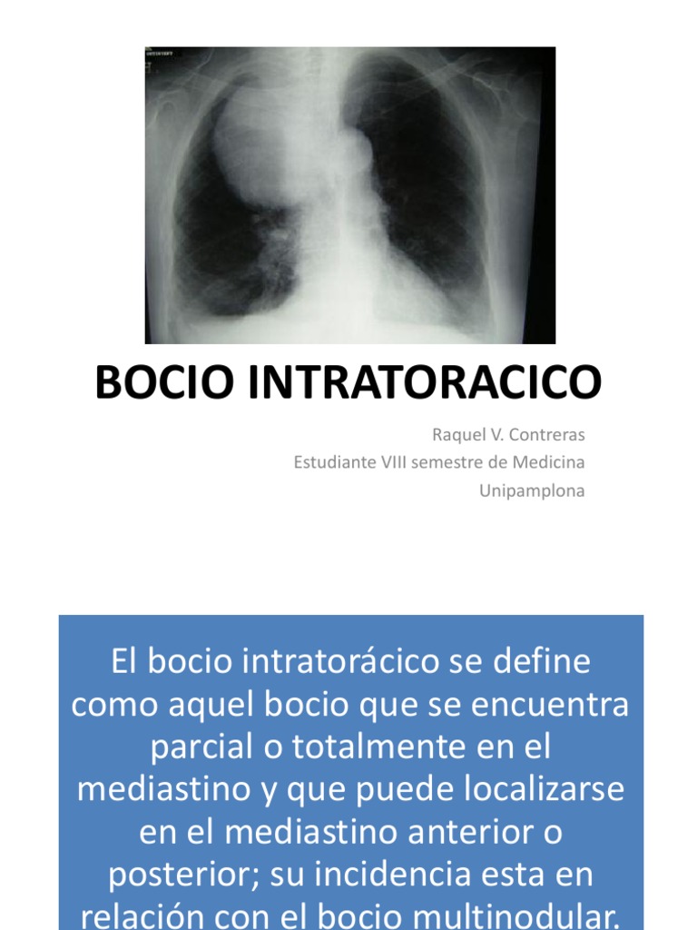 BOCIO INTRATORACICO