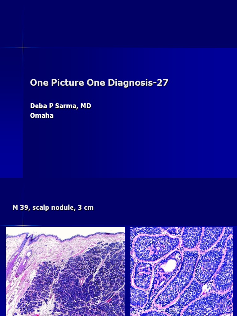 One Picture One Diagnosis-27 (Cylindroma) | PDF