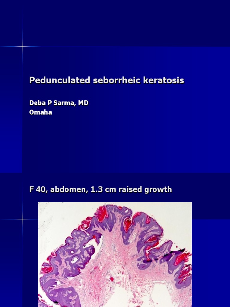 Seborrheic Keratosis, Pedunculated Type, F 40, Abdomen. | PDF | Home ...