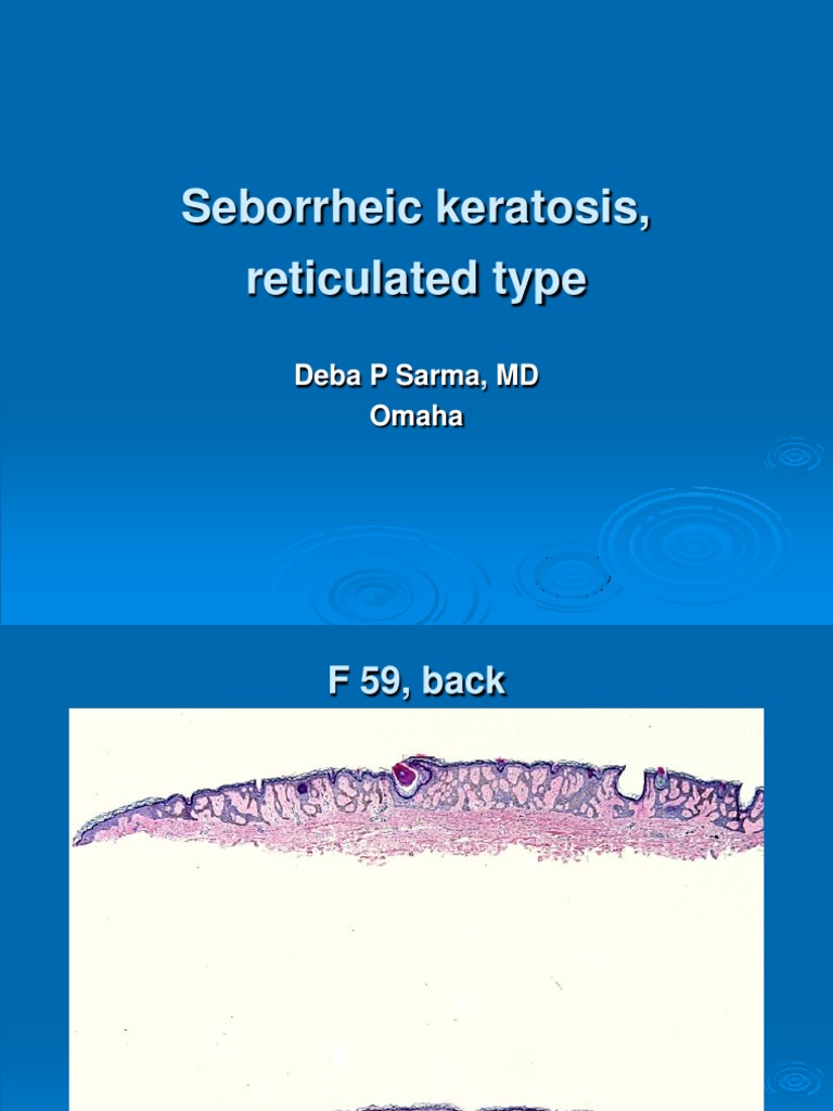 Seborrheic Keratosis, Reticulated Type. F 59, Back | PDF