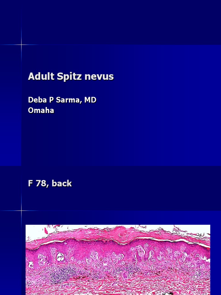 Spitz Nevus, Adult, F 78, Back | PDF