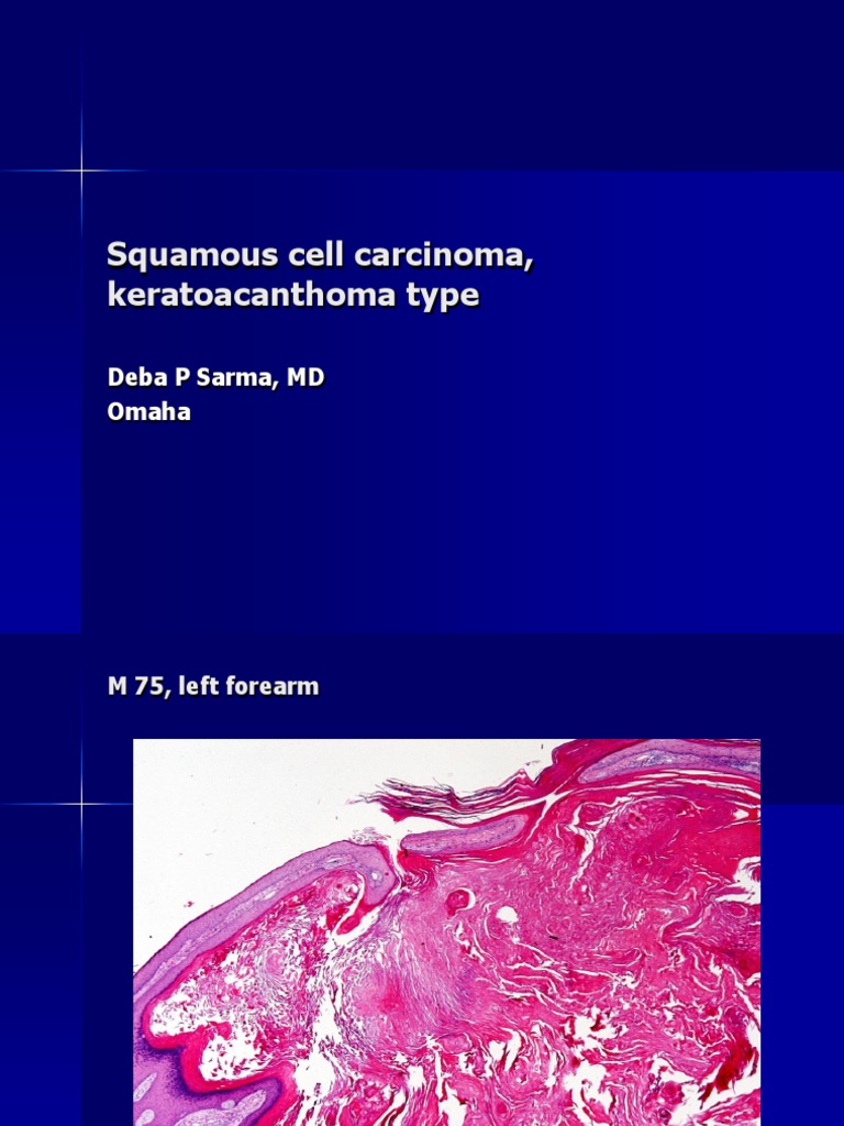 Squamous Cell Carcinoma, Keratoacanthoma Type., M 75, Left Forearm. | PDF