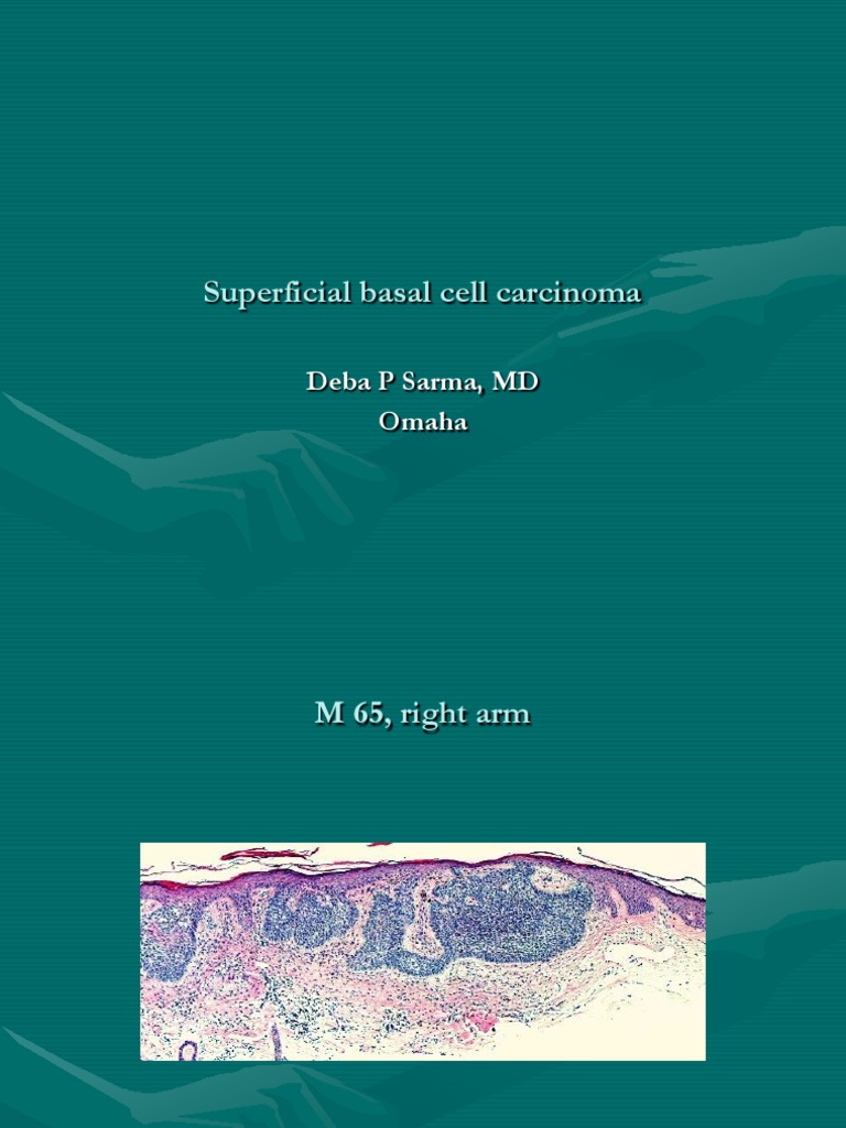Superficial Basal Cell Carcinoma, M 65, Right Arm | PDF