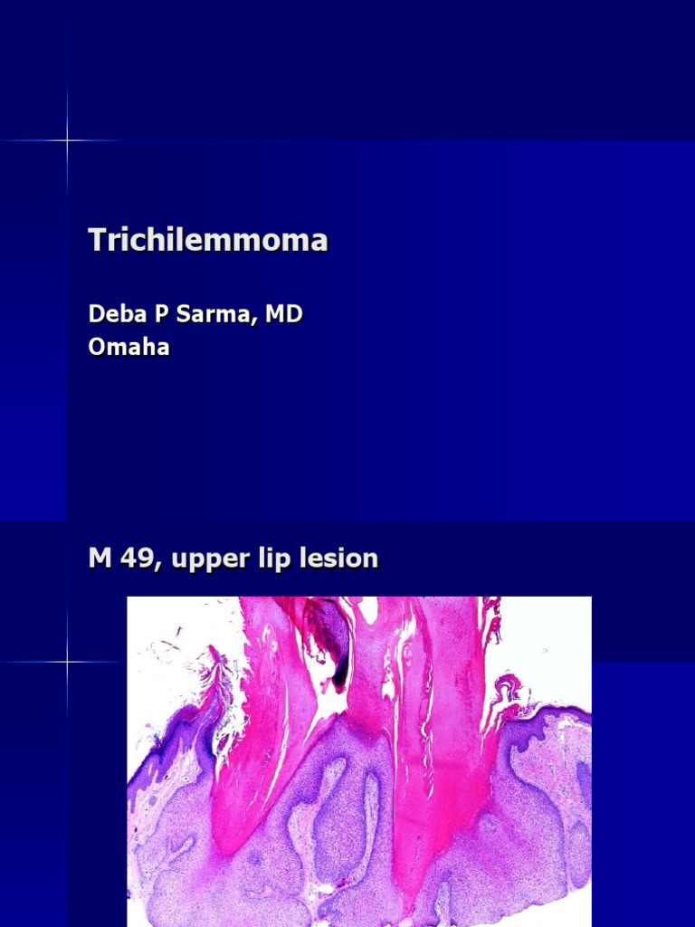 Trichilemmoma, M 49, Upper Lip | PDF