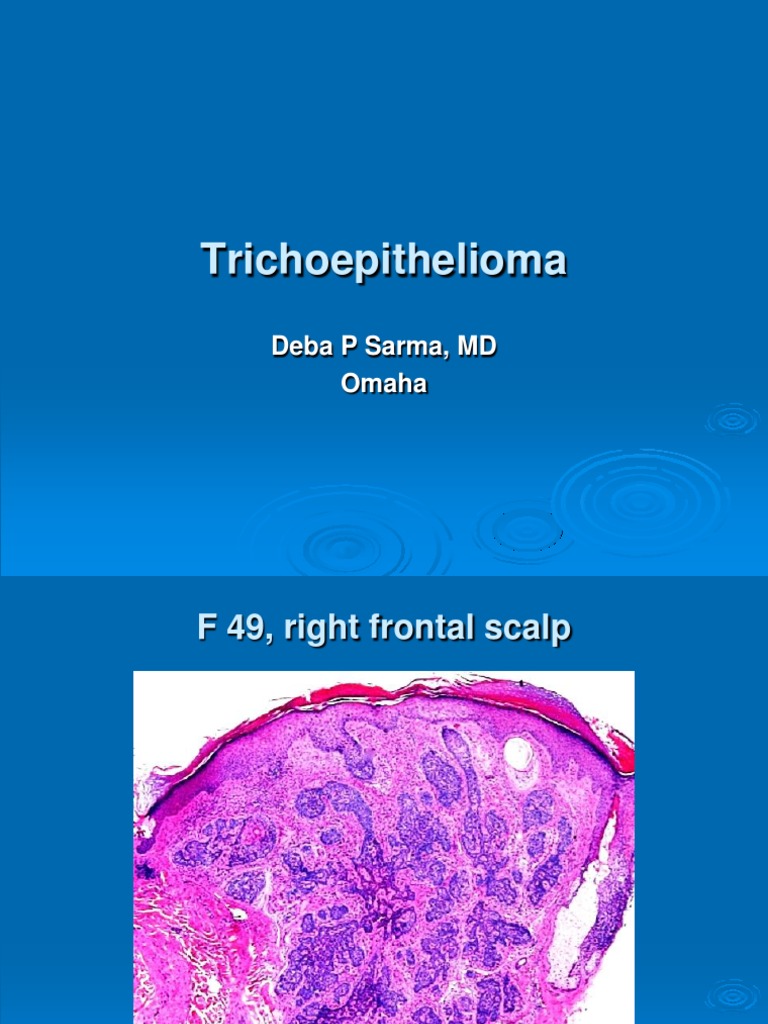 Trichoepithelioma. F 49, Right Frantal Scalp | PDF