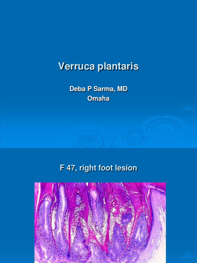 Verruca Plantaris, F 47, Right Foot | PDF