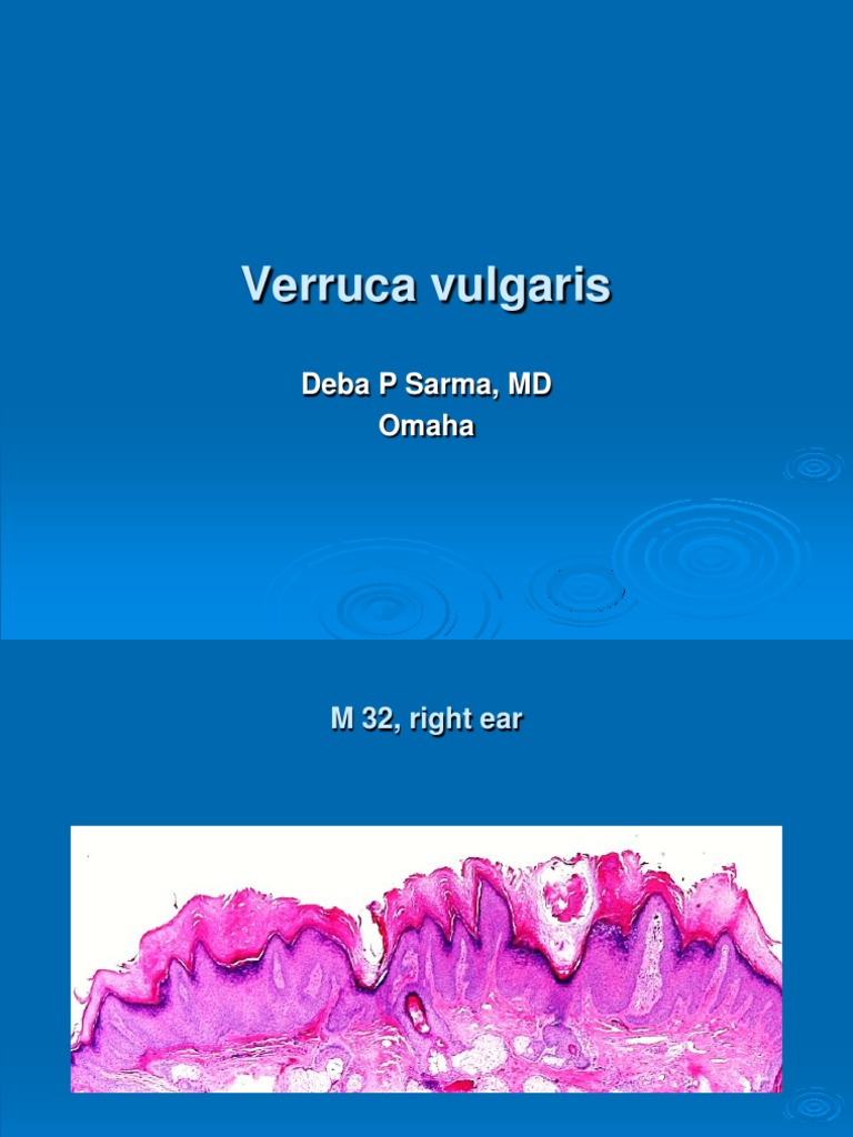 Verruca Vulgaris, M 32, Right Ear | PDF