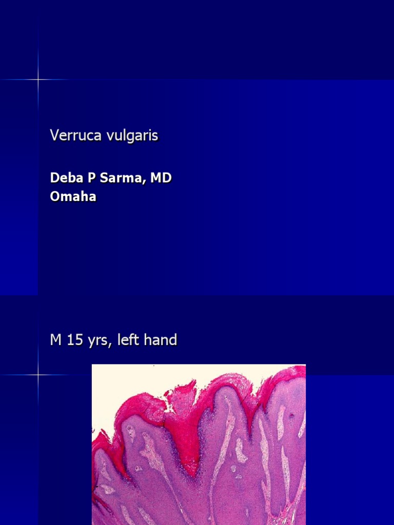 Understanding Verruca Vulgaris Pathology | PDF